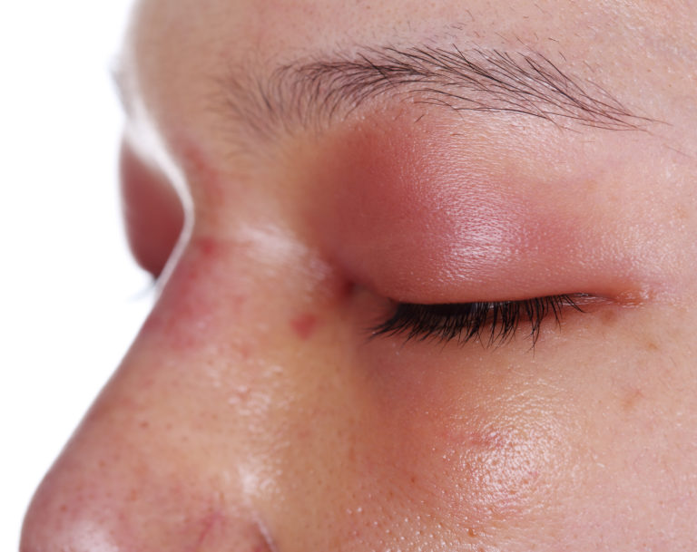 Augenentzündung: Entzündete Augen – Heilpraxis