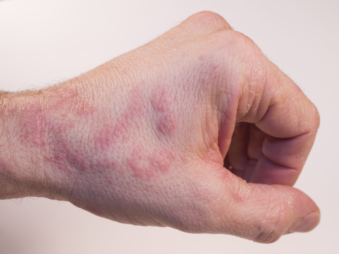 Symptome eines chronischen Handekzems diagnostizieren – Heilpraxis