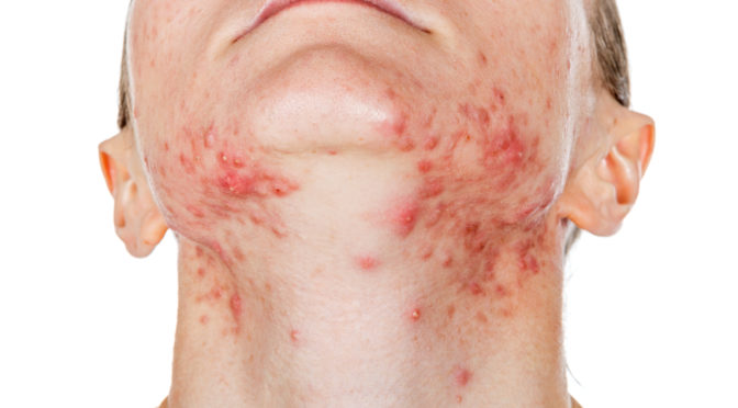 Ausschlag im Gesicht