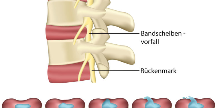 Nach einem Bandscheibenvorfall: Therapie und Diagnostik mit ... Nach einem Bandscheibenvorfall: Therapie und Diagnostik mit ...
