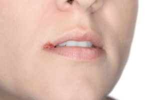 Augenherpes: Ursachen, Behandlung und Hausmittel – Heilpraxis