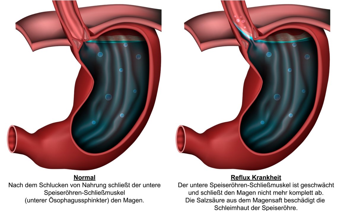 Reflux – Ursachen, Symptome, Behandlung – Heilpraxis