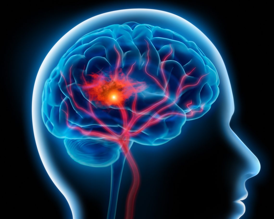 Gehirnblutung – Ursachen, Symptome und Therapie – Heilpraxis Gehirnblutung – Ursachen, Symptome und Therapie – Heilpraxis