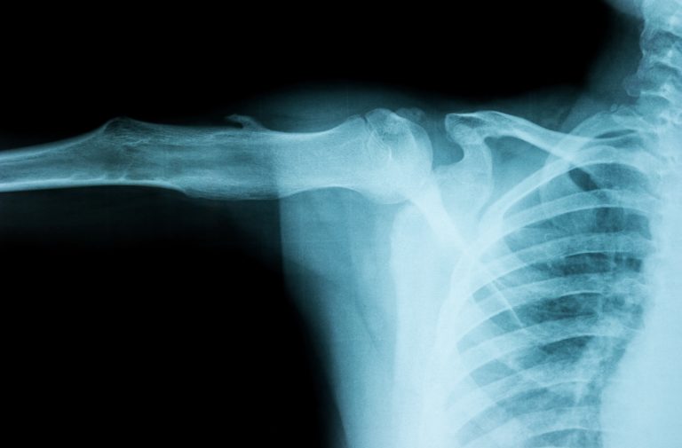 Schmerzen beim Arm heben – Ursachen, Symptome und Behandlung – Heilpraxis