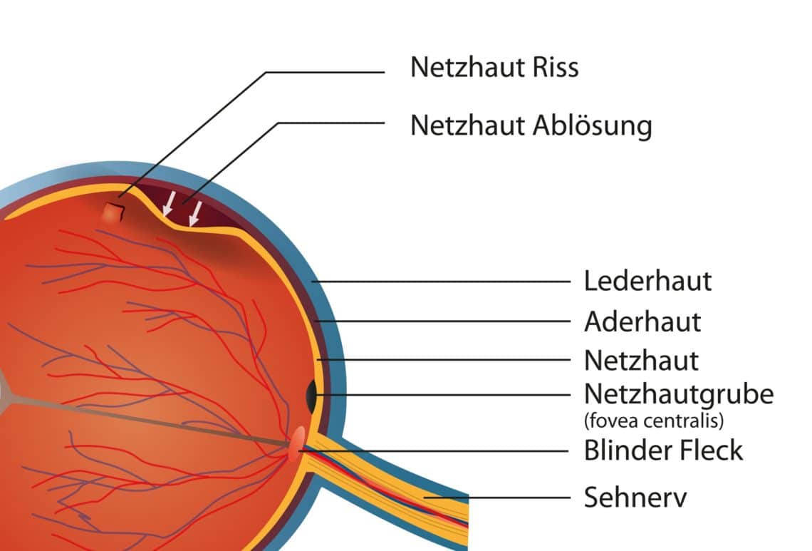 Loch in der Netzhaut – Netzhautlöcher – Heilpraxis