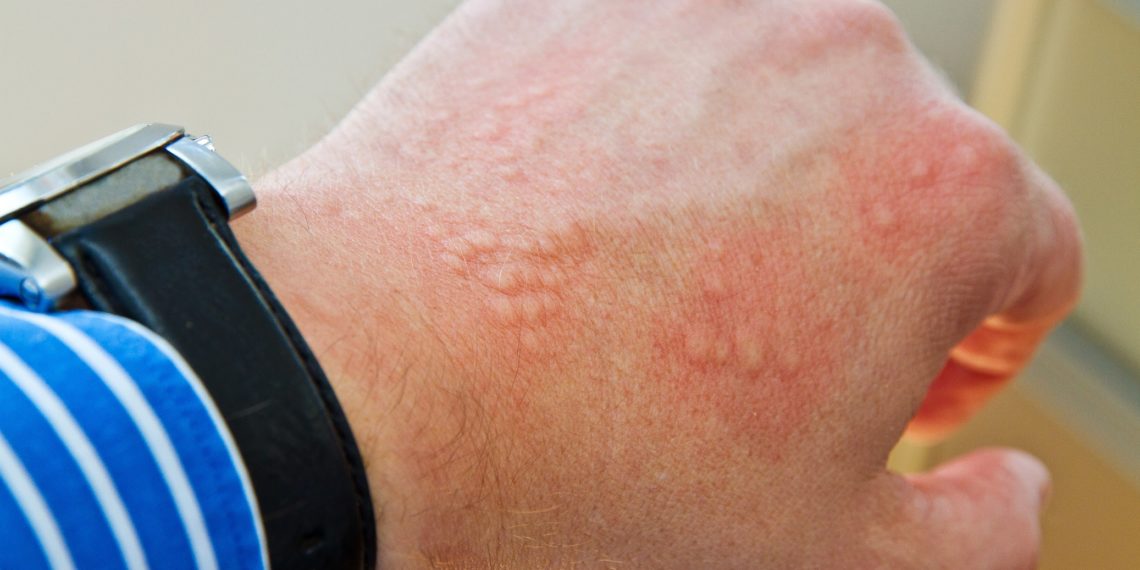 Nesselsucht – Wenn unsere Haut plötzlich juckende Quaddeln bildet ...