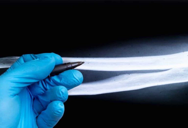 Knochenmark­entzündung (Osteomyelitis) – Symptome, Ursachen und ...