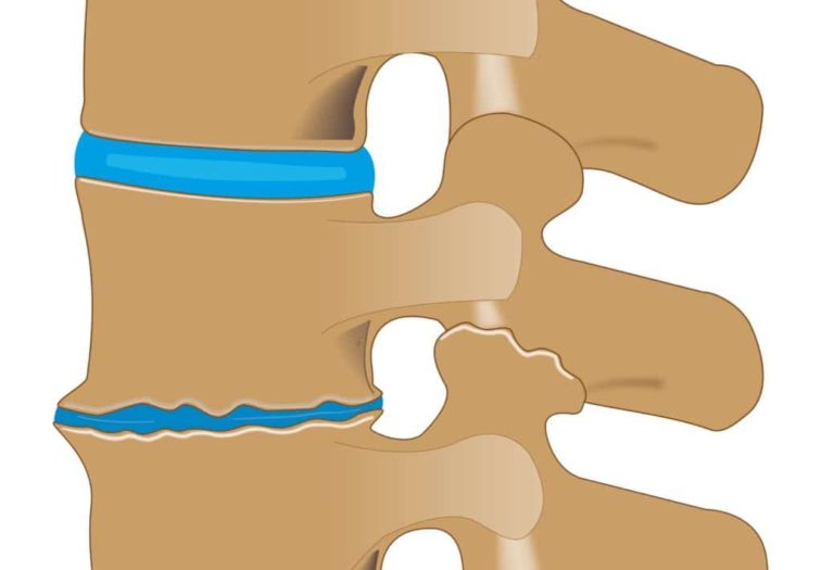 Osteochondrose – Symptome, Ursachen und Behandlung – Heilpraxis