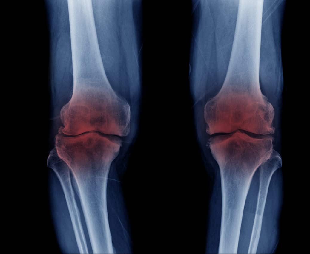 Osteochondrose – Symptome, Ursachen und Behandlung – Heilpraxis