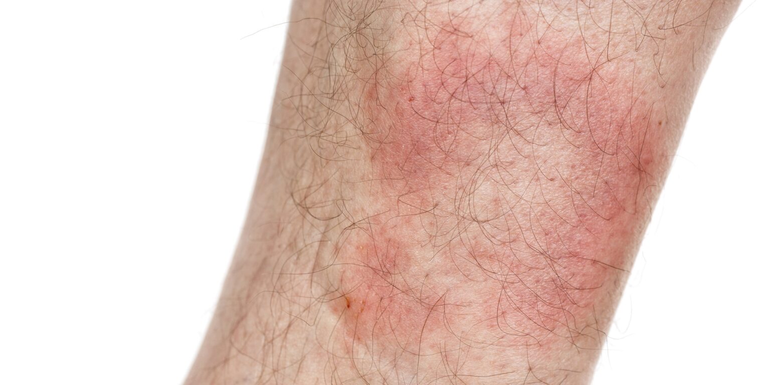 Erythema migrans – Ursachen und Behandlung – Heilpraxis
