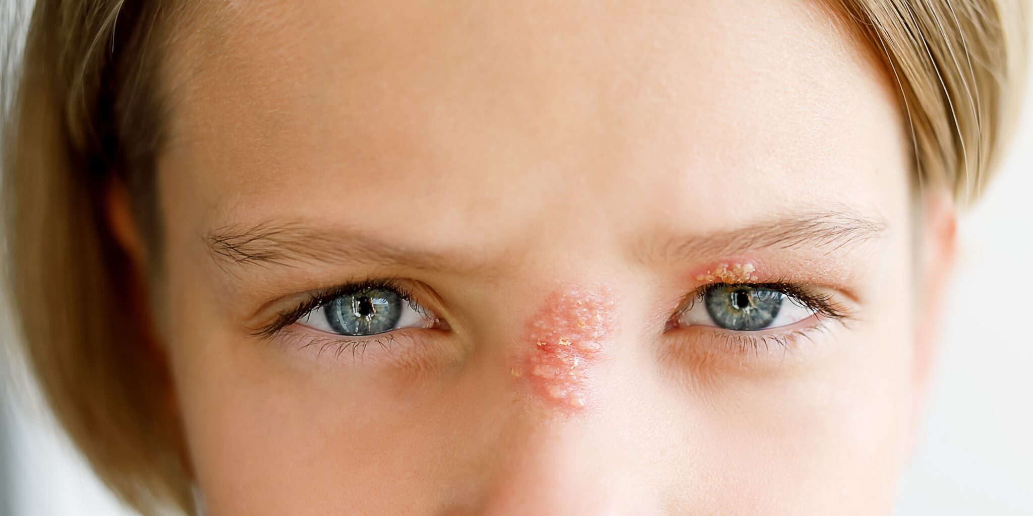 Augenherpes: Ursachen, Behandlung und Hausmittel – Heilpraxis