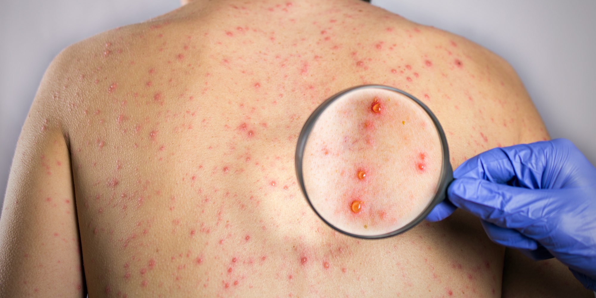 Ausschlag am ganzen Körper – Heilpraxis