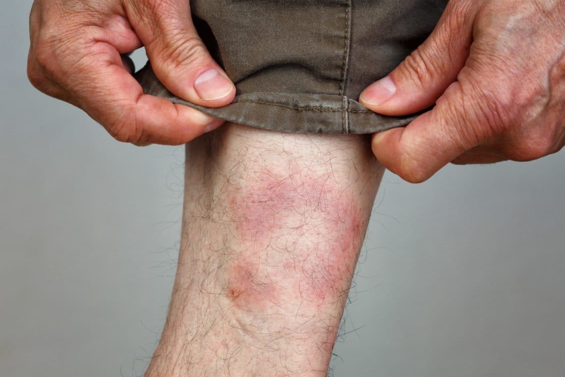 Borreliose – Symptome, Behandlung und Verlauf – Heilpraxis