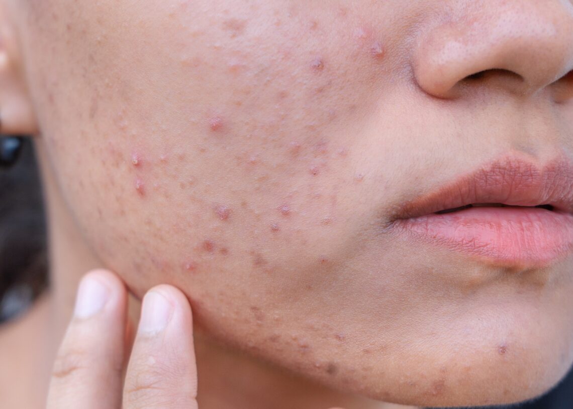 Lippenkrebs – Ursachen, Symptome und Behandlung – Heilpraxis