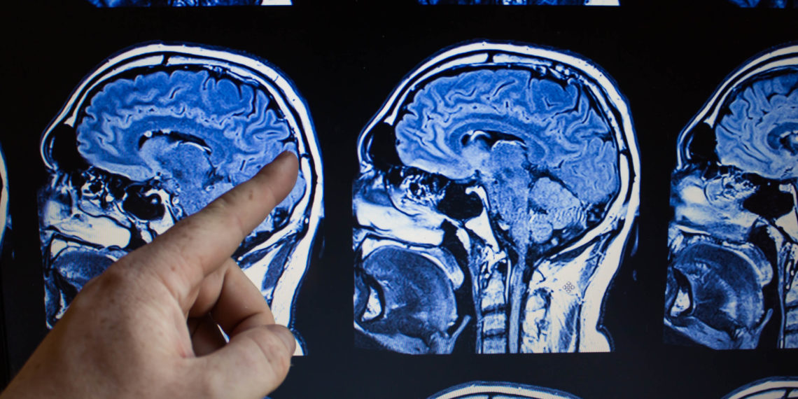 Gehirntumor: Diese wichtigen Warnzeichen sollte man kennen – Heilpraxis