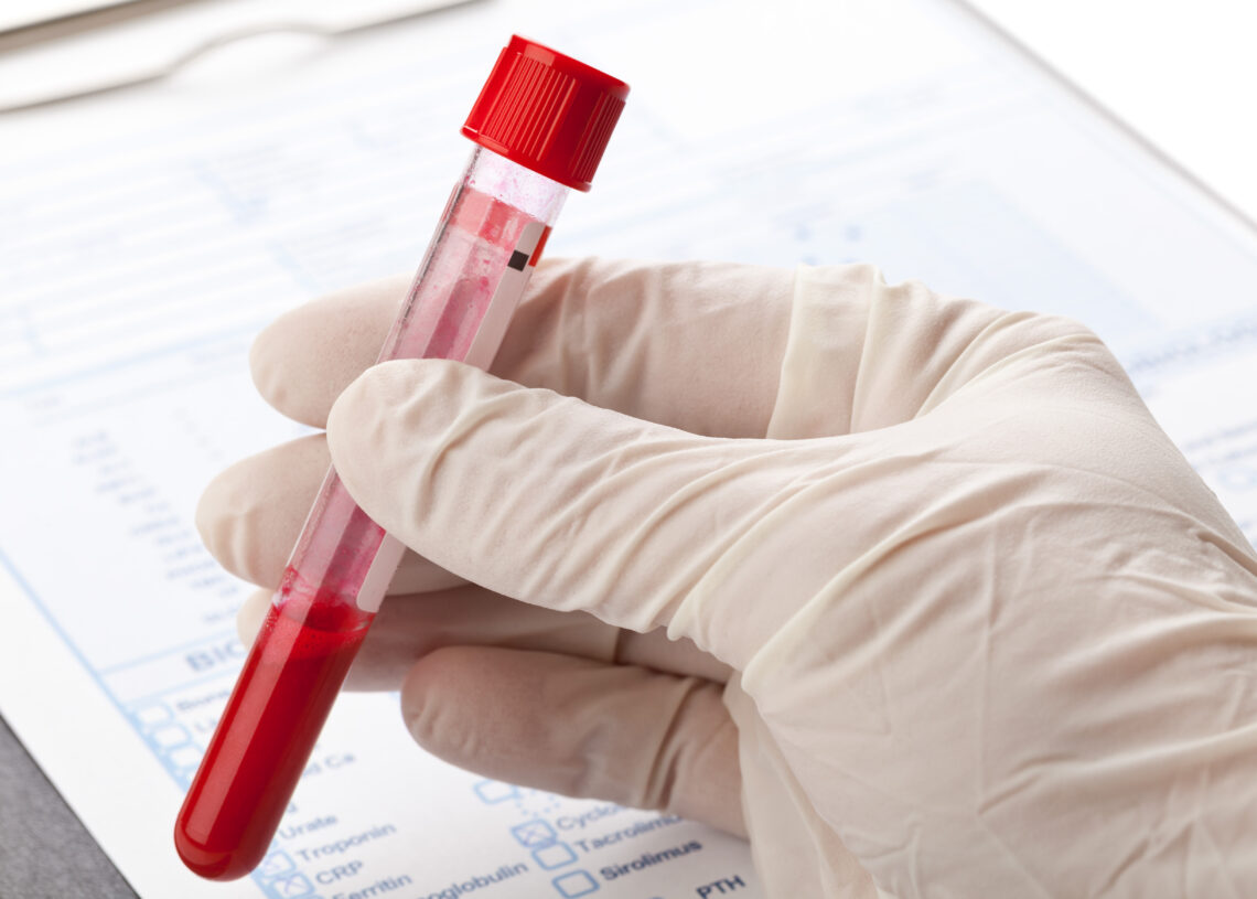 Raucherbein (pAVK) – Ursachen, Symptome, Therapie – Heilpraxis