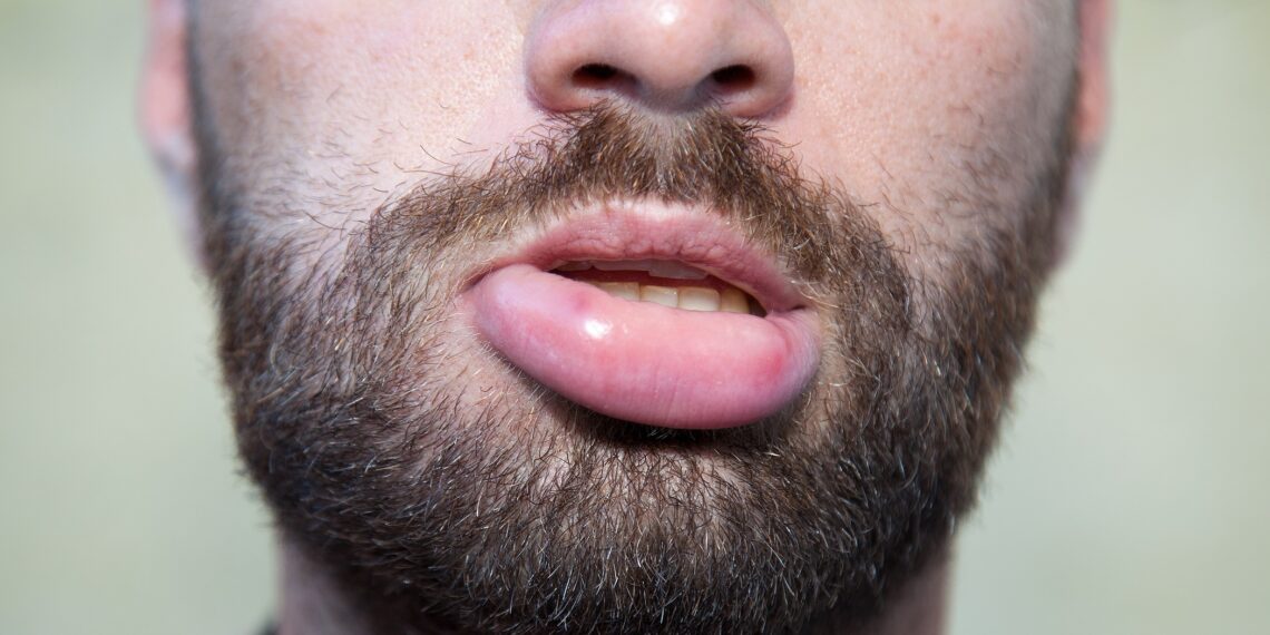 Spannende Geschwollene Lippen Erkltung Bild