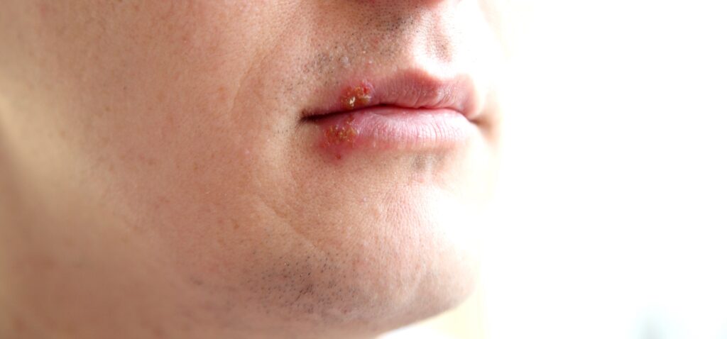 Spannende Geschwollene Lippen Erkltung Bild
