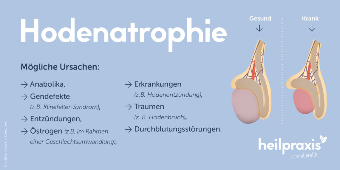 Hodenatrophie – Ursachen, Symptome und Behandlung – Heilpraxis