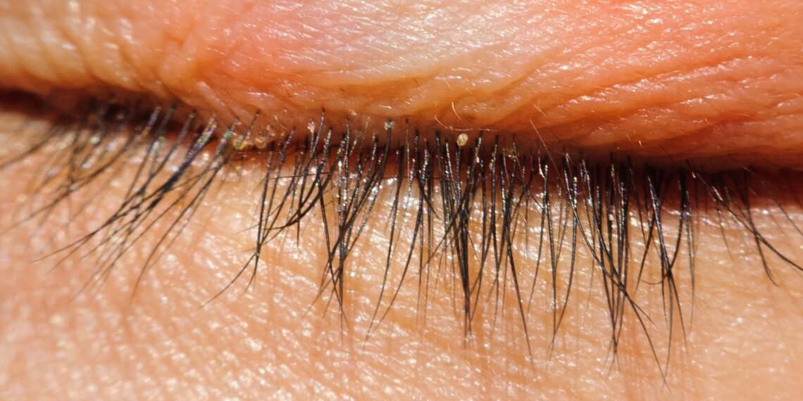 Augenmilben – Ursachen, Symptome und Behandlung – Heilpraxis